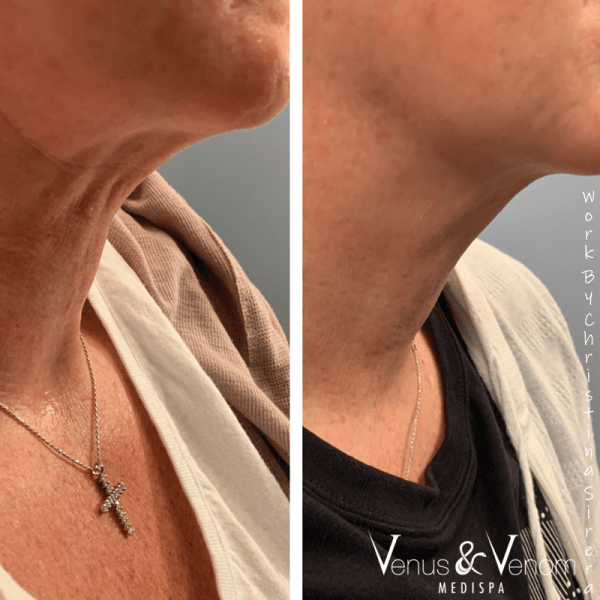 MicroTOX® | Venus & Venom Medispa | Injectable Services